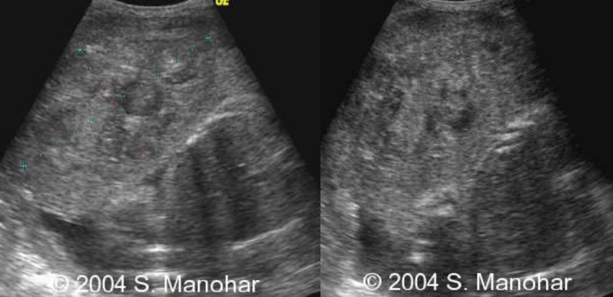  Abruptio Placenta