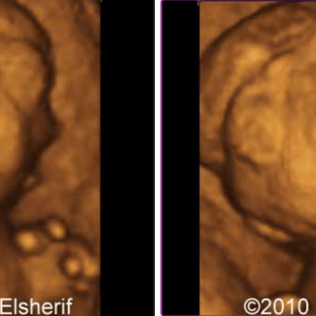 📃 Schinzel phocomelia syndrome