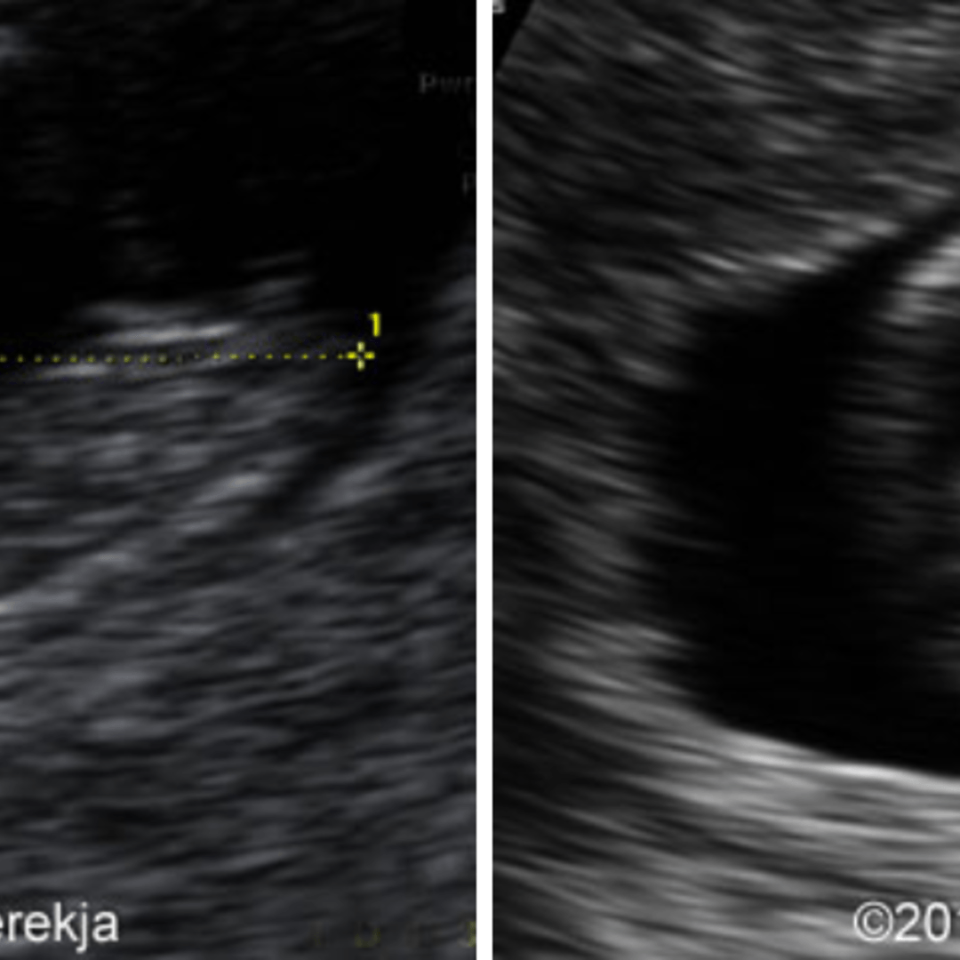 📃 Triploidy with hydrocephaly, first trimester
