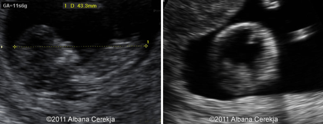 📃 Triploidy with hydrocephaly, first trimester