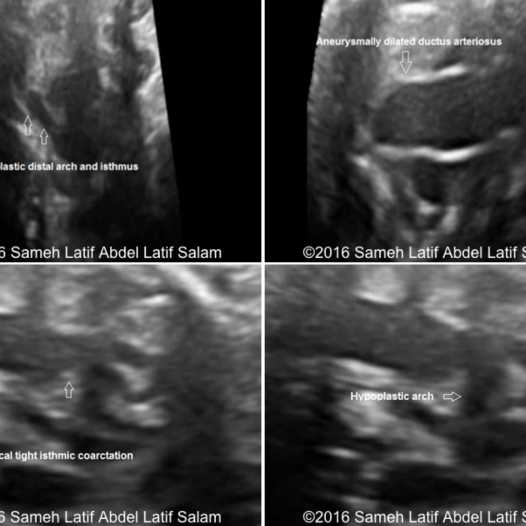 📃 Tubular hypoplasia of the aortic arch with critical coarctation