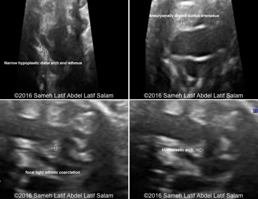 📃 Tubular hypoplasia of the aortic arch with critical coarctation