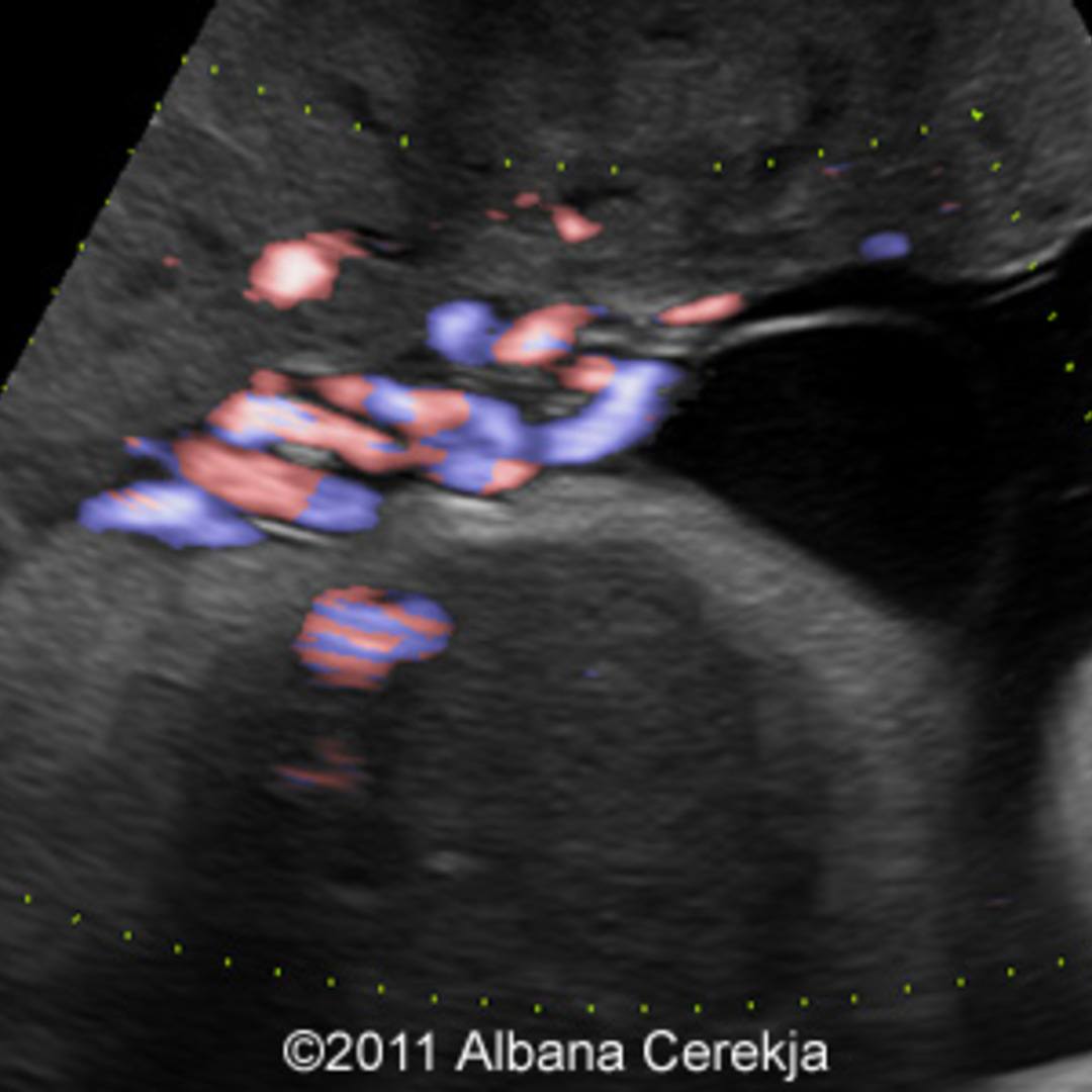 📃 Subamniotic cyst