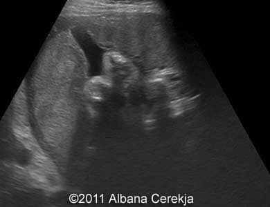 📃 Succenturiate placenta