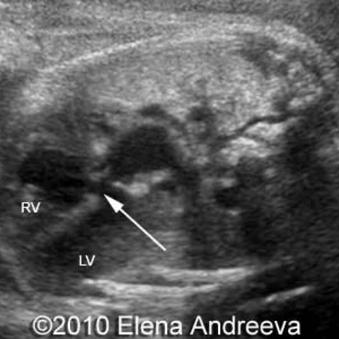 📃 Taussig-Bing complex