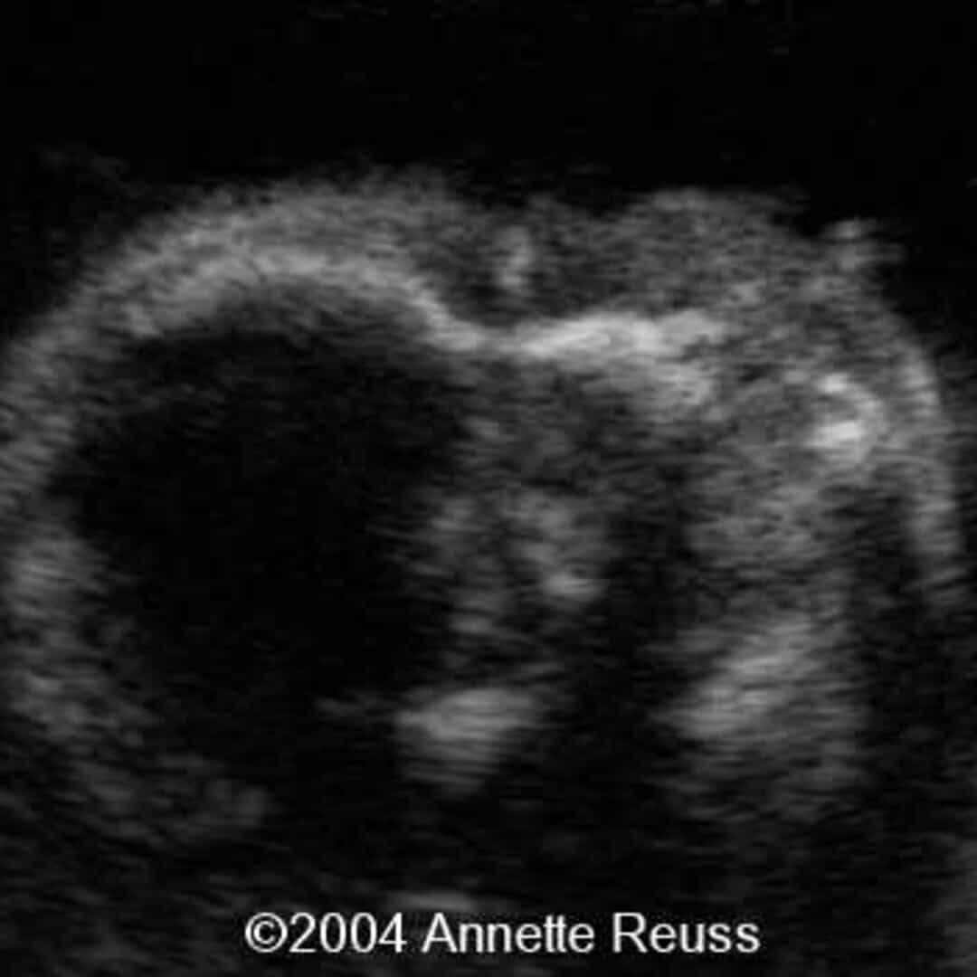 📃 Townes-Brocks syndrome