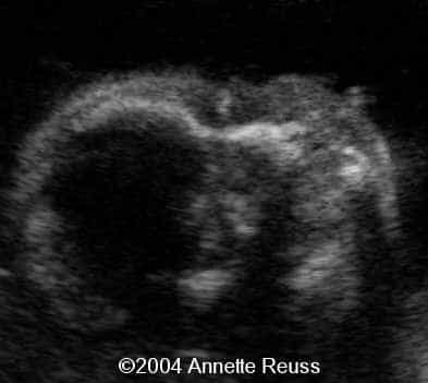📃 Townes-Brocks syndrome
