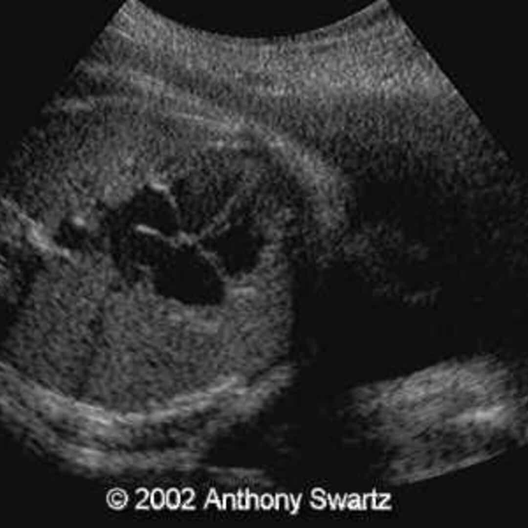 📃 Premature closure of the foramen ovale