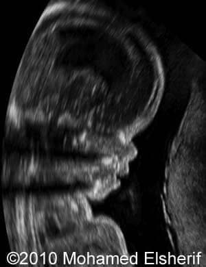 cloverleaf skull fetal ultrasound