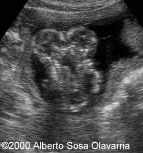 📃 Twins, conjoined , omphalo-thoracopagus, 1st trim