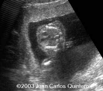 mesomelia fetal