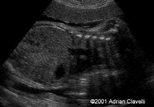 📃 Asphyxiating thoracic dystrophy