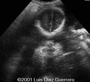 📃 Craniosynostosis: cloverleaf skull