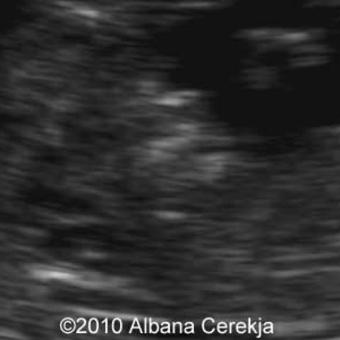 📃 Partial mole in the second trimester