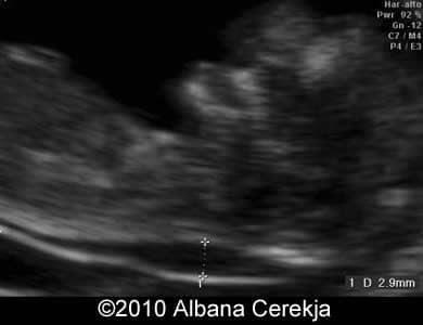 📃 Trisomy 13 with megacystis in the first trimester
