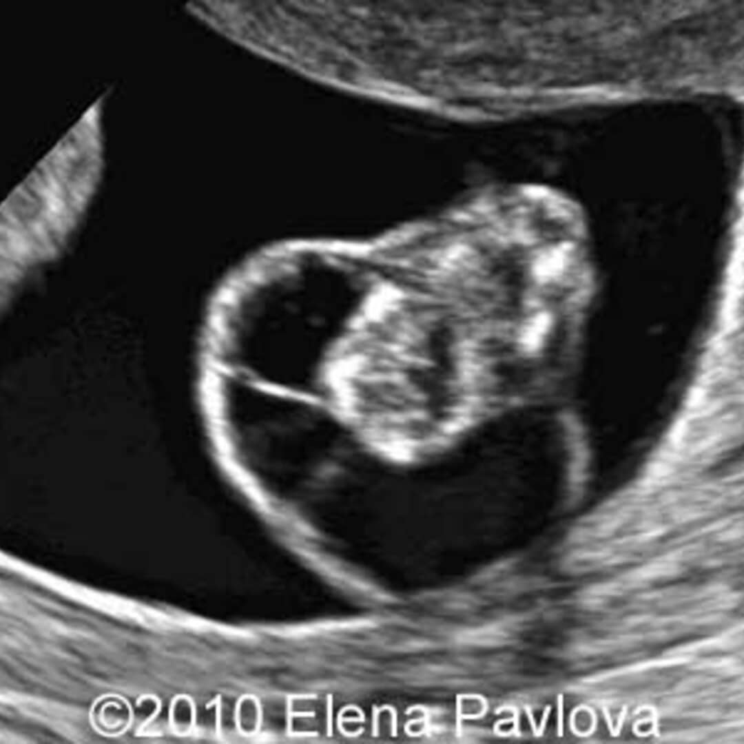 📃 Monosomy X at 12 weeks of gestation