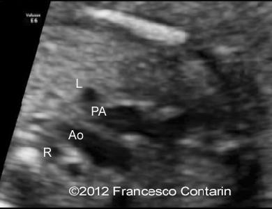 📃 Persistent left superior vena cava