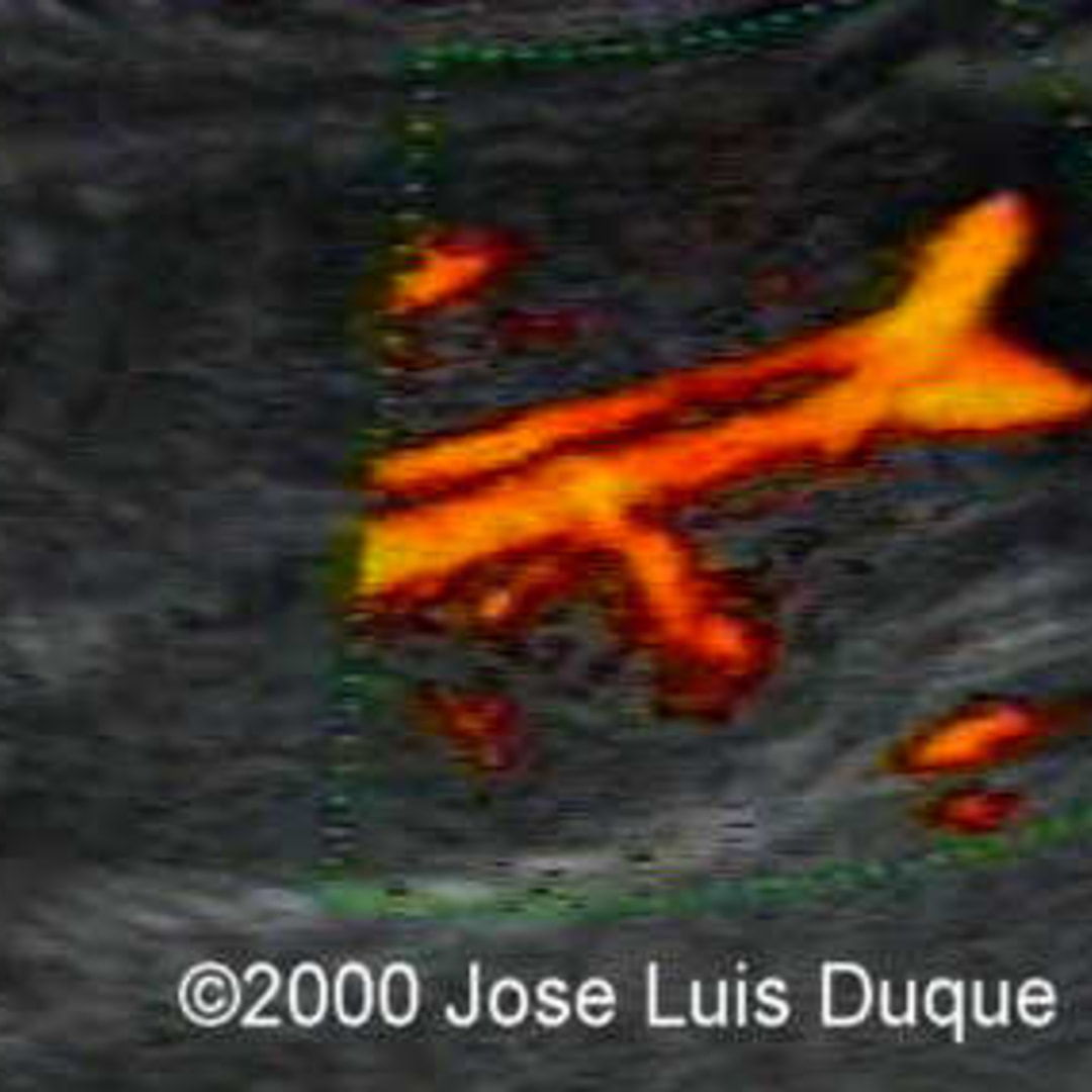 📃 Unilateral renal agenesis