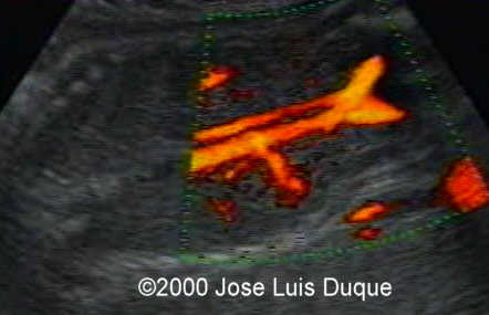 📃 Unilateral renal agenesis