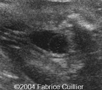 📃 Ureterocele