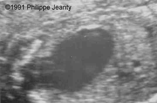 📃 Urethral meatus agenesis