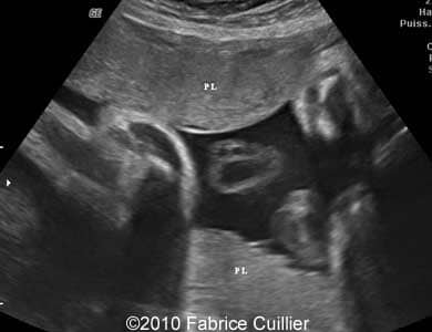 📃 Vasa previa with bilobate placenta