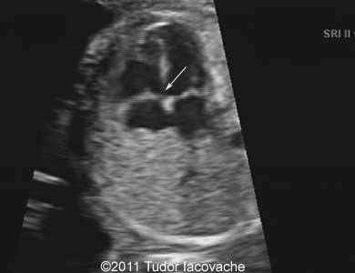 📃 Truncus arteriosus