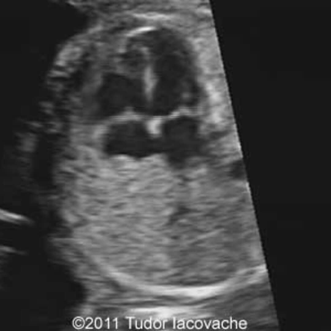 📃 Truncus arteriosus