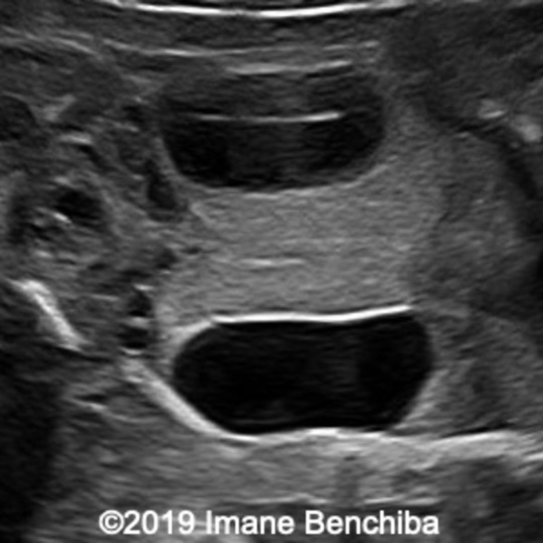 📃 Bilateral urinoma