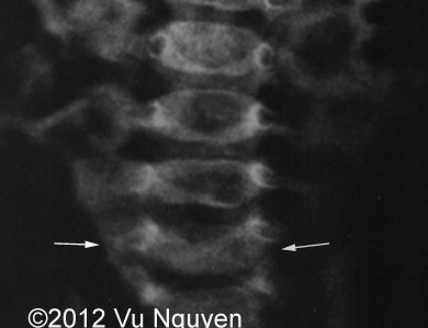 📃 Butterfly vertebra